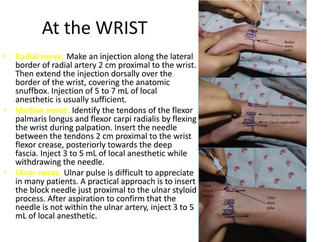Upper limb blocks | PPT | First Aid | Injuries