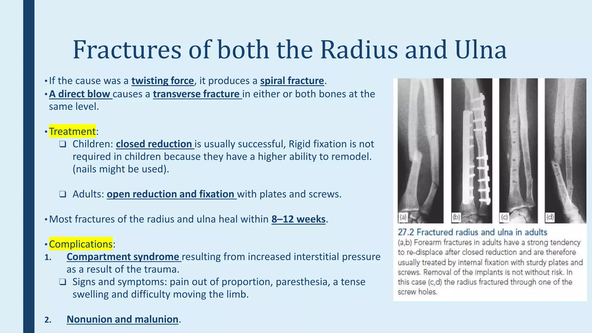 Upper limb fractures | PPTX
