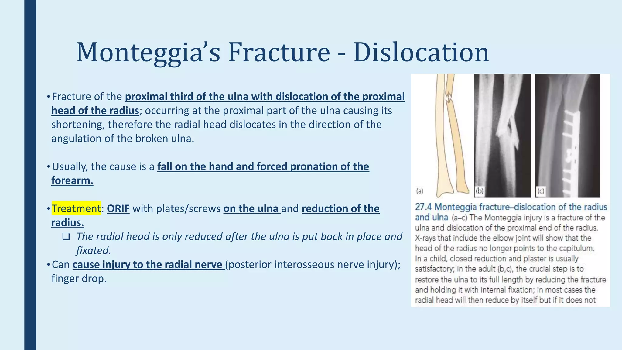 Upper limb fractures | PPTX