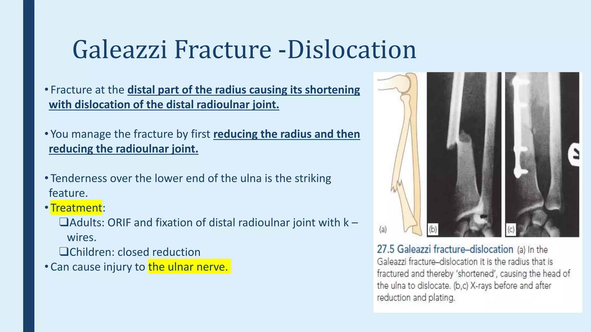 Upper limb fractures | PPTX