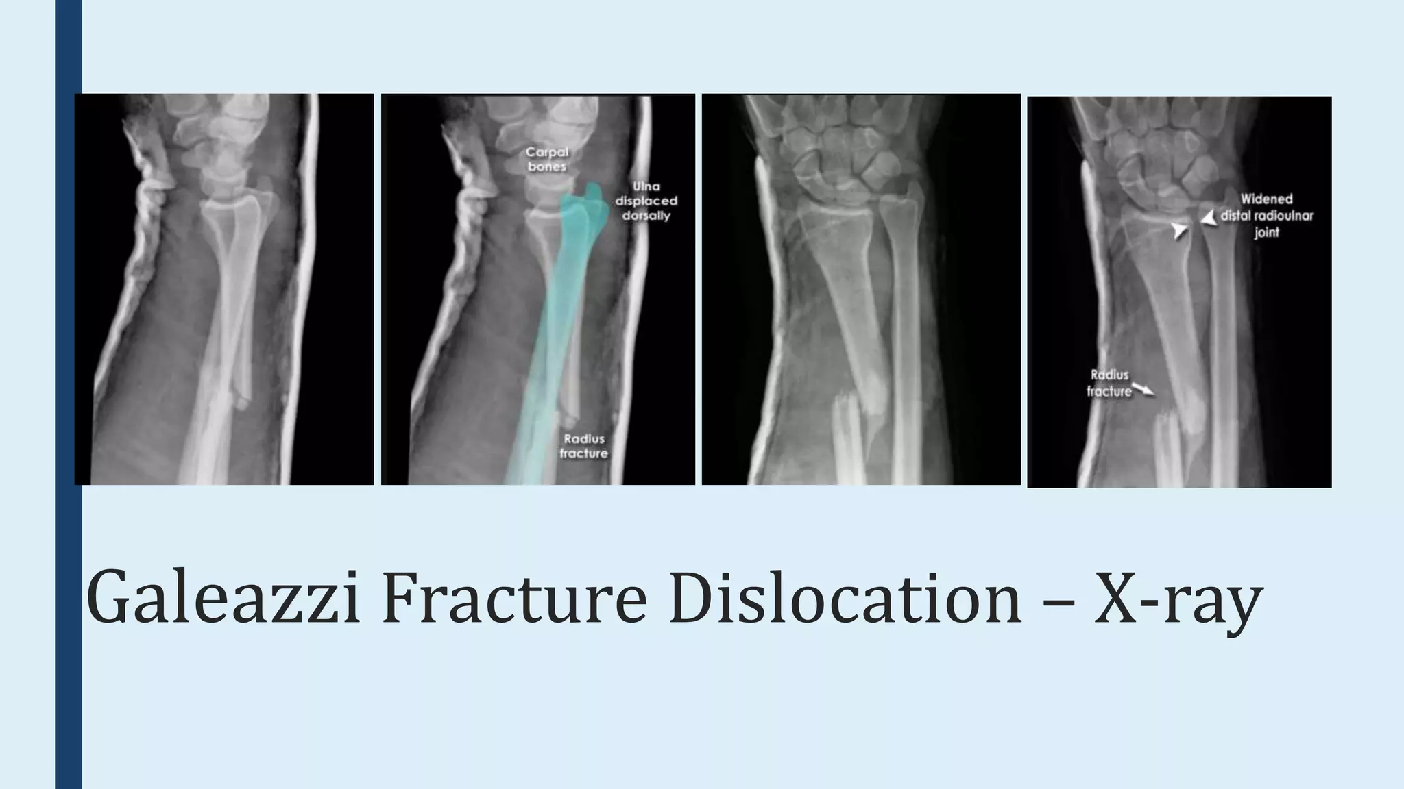 Upper limb fractures | PPTX