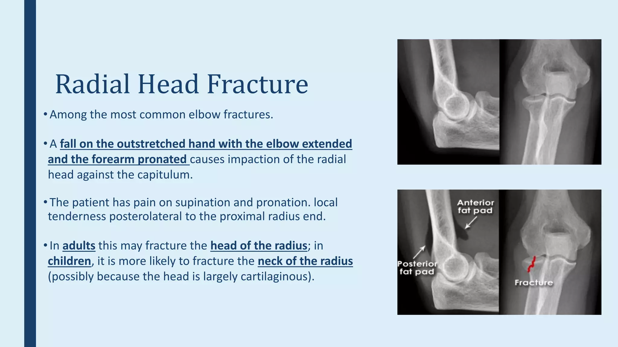 Upper limb fractures | PPTX