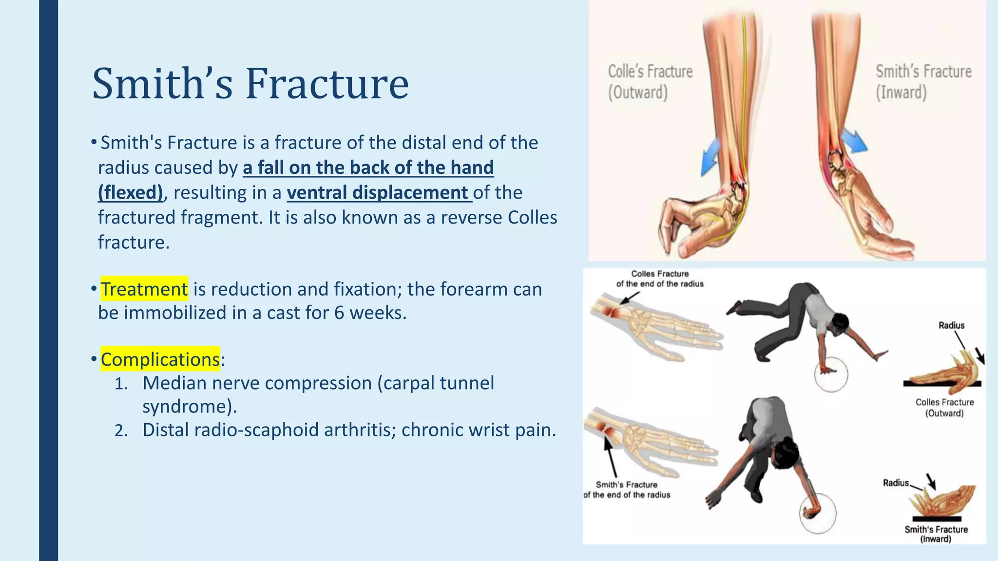 Upper limb fractures | PPTX
