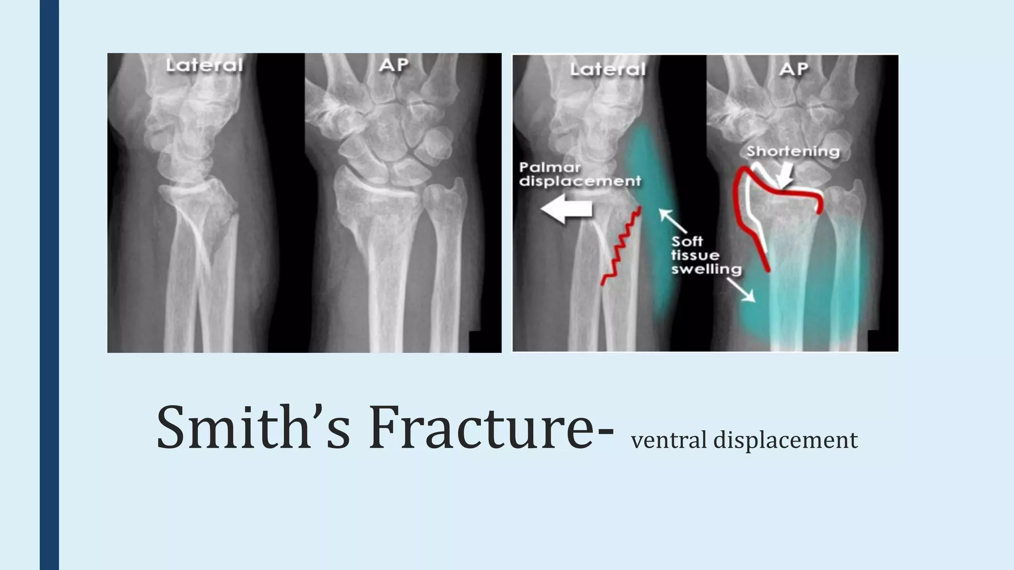 Upper limb fractures | PPTX