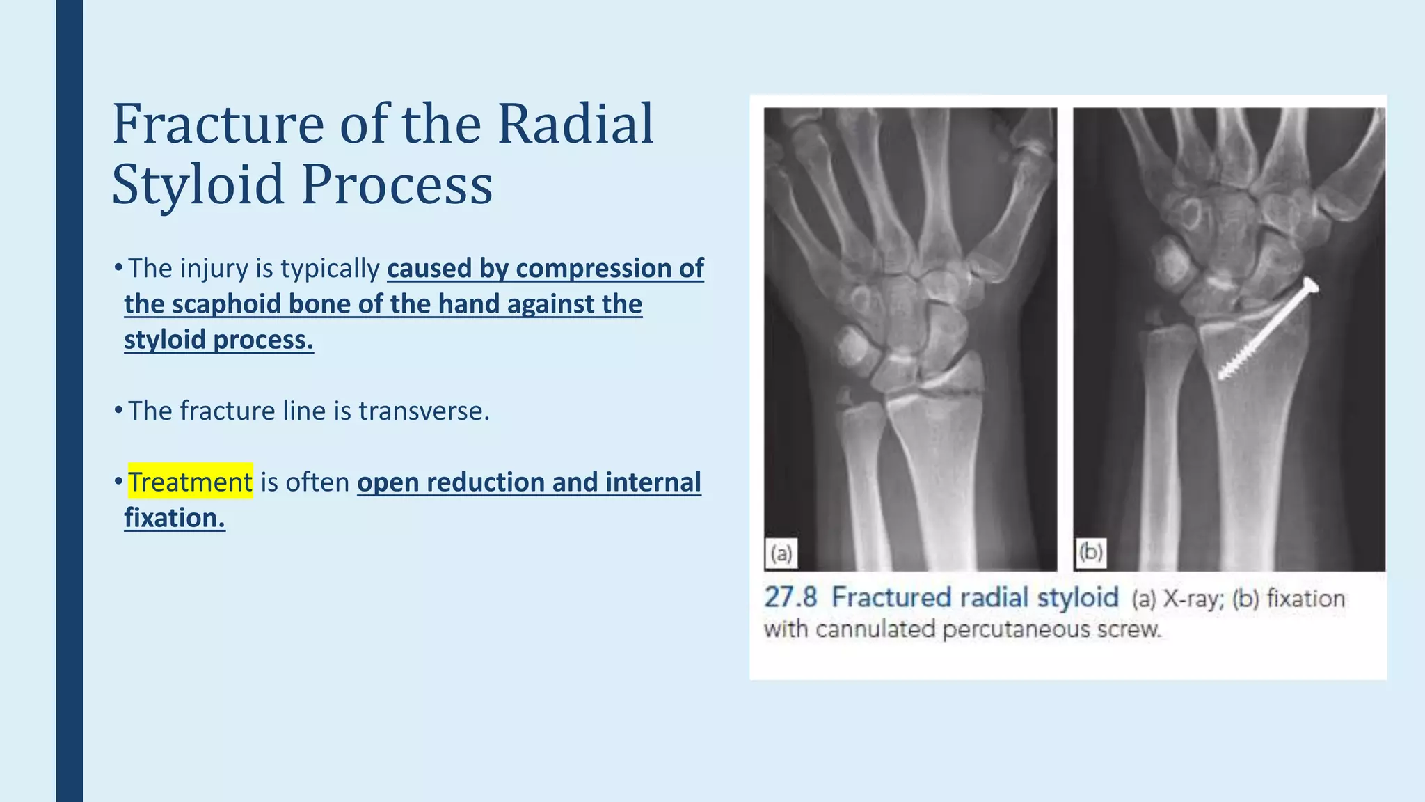 Upper limb fractures | PPTX