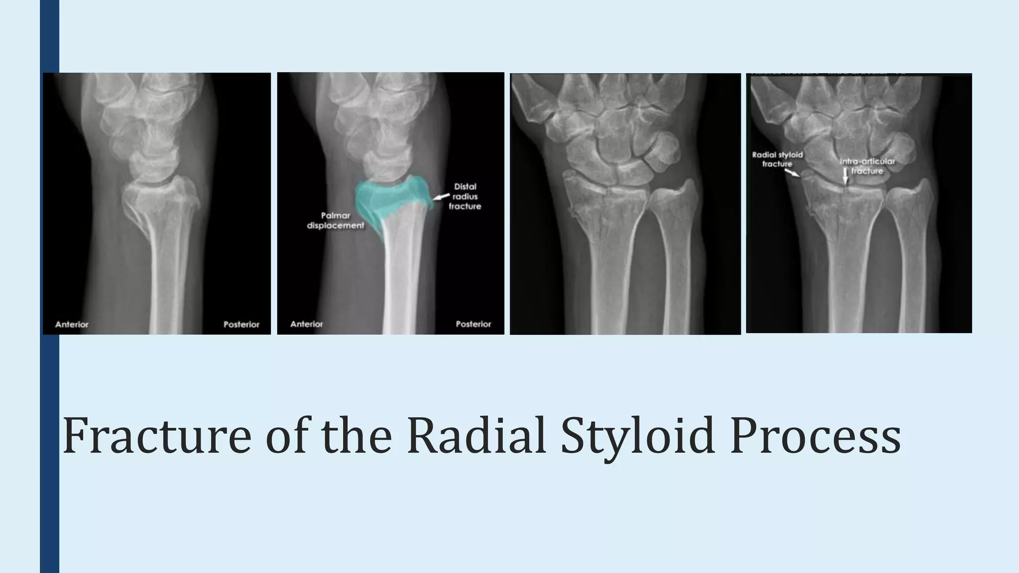 Upper limb fractures | PPTX