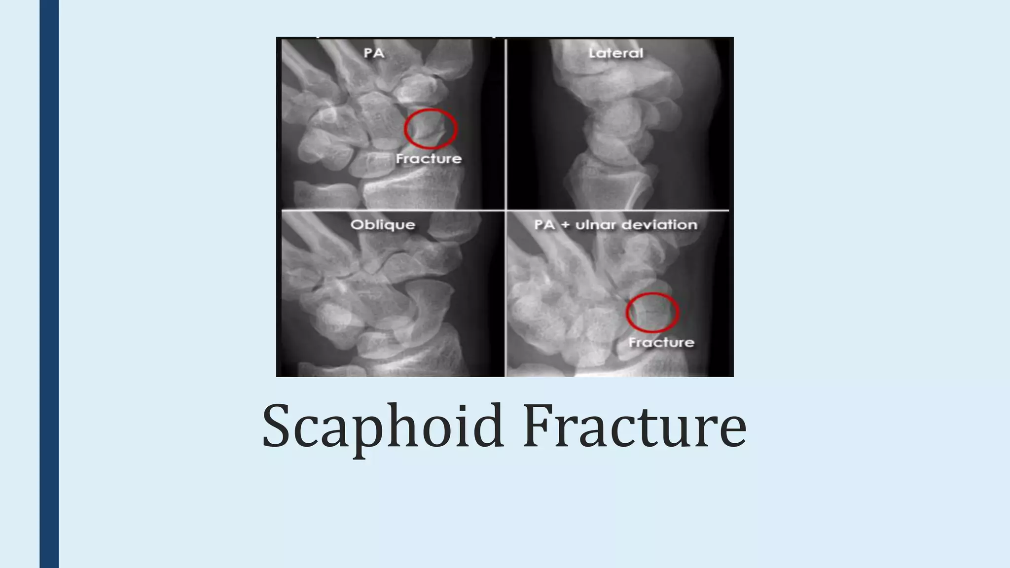 Upper limb fractures | PPTX