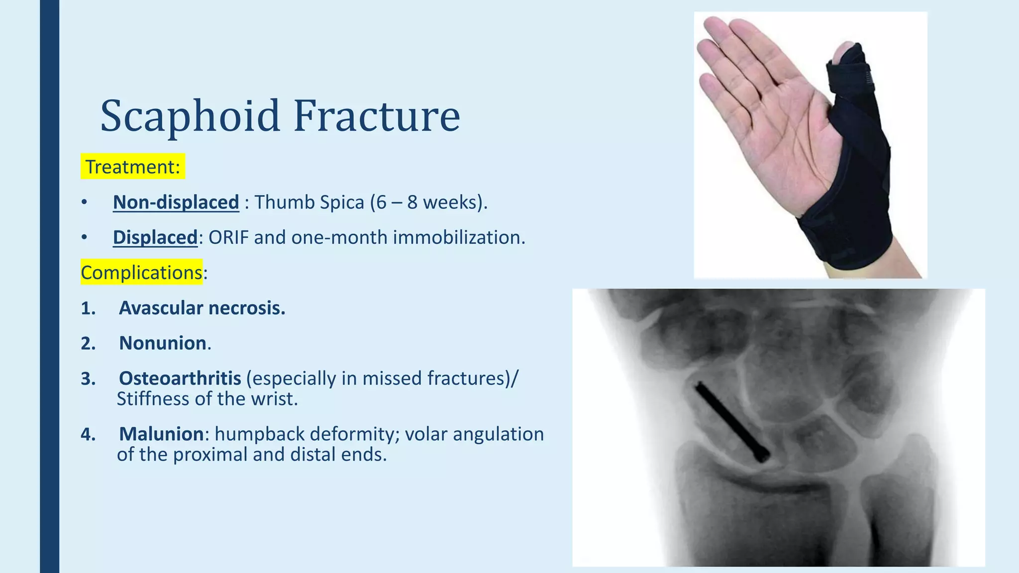 Upper limb fractures | PPTX