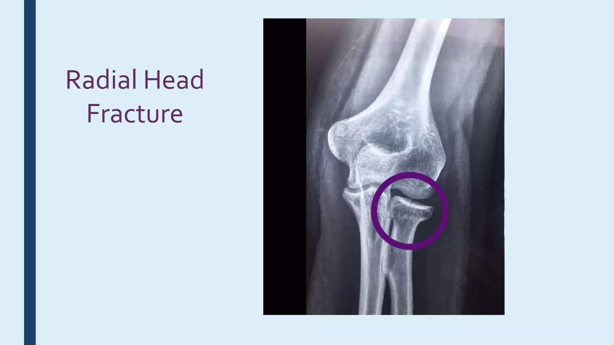 Upper limb fractures | PPTX