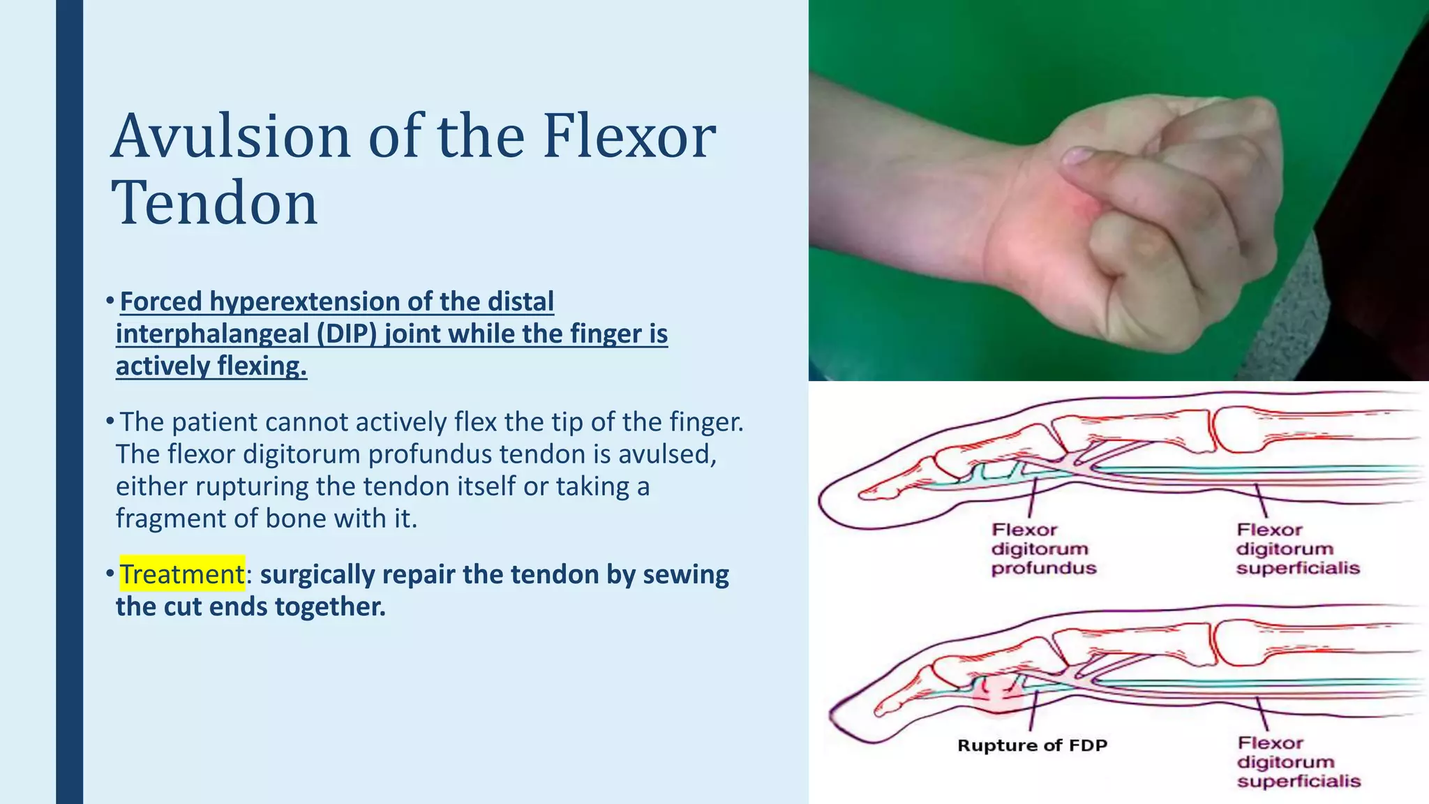 Upper limb fractures | PPTX