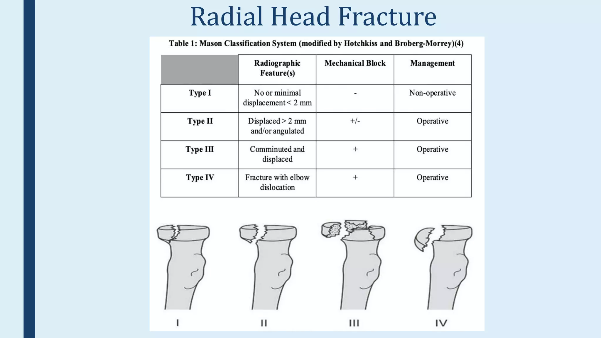 Upper limb fractures | PPTX