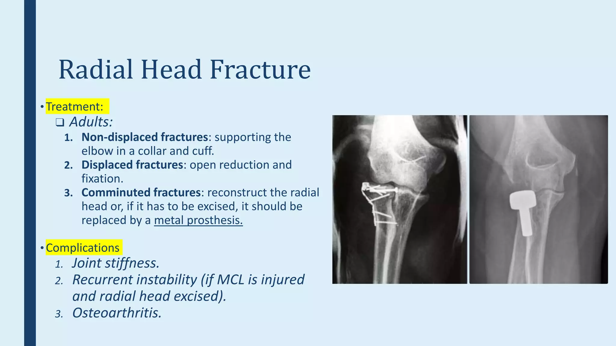 Upper limb fractures | PPTX