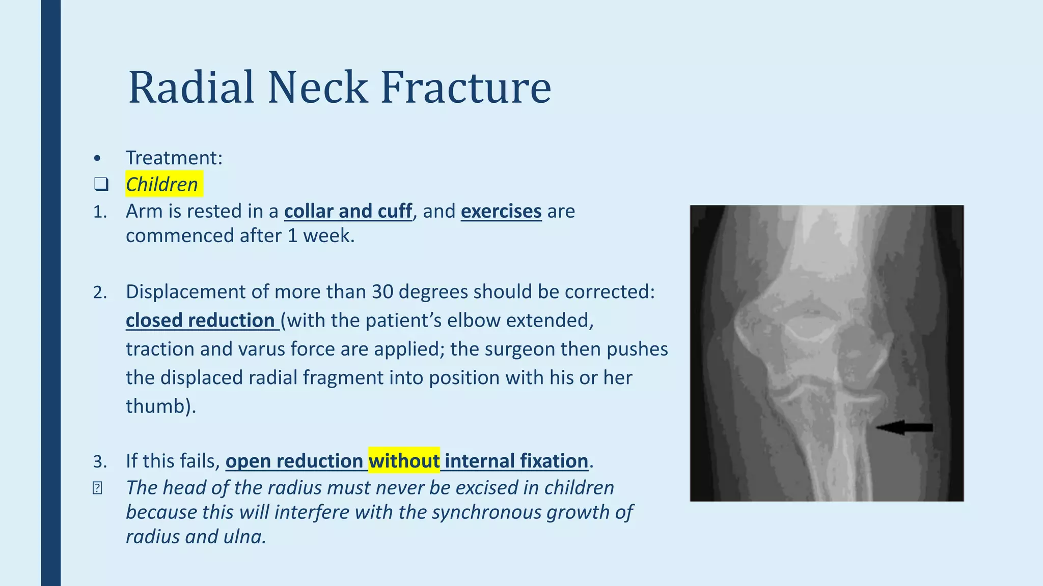 Upper limb fractures | PPTX