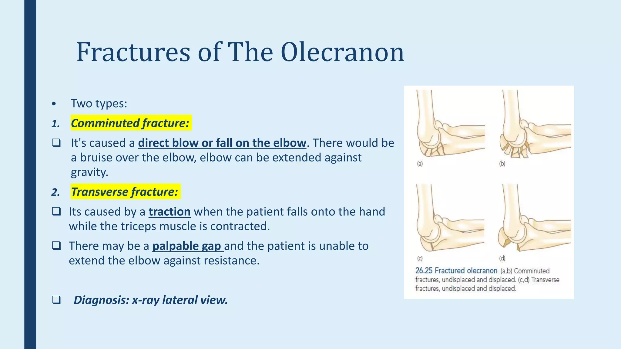 Upper limb fractures | PPTX