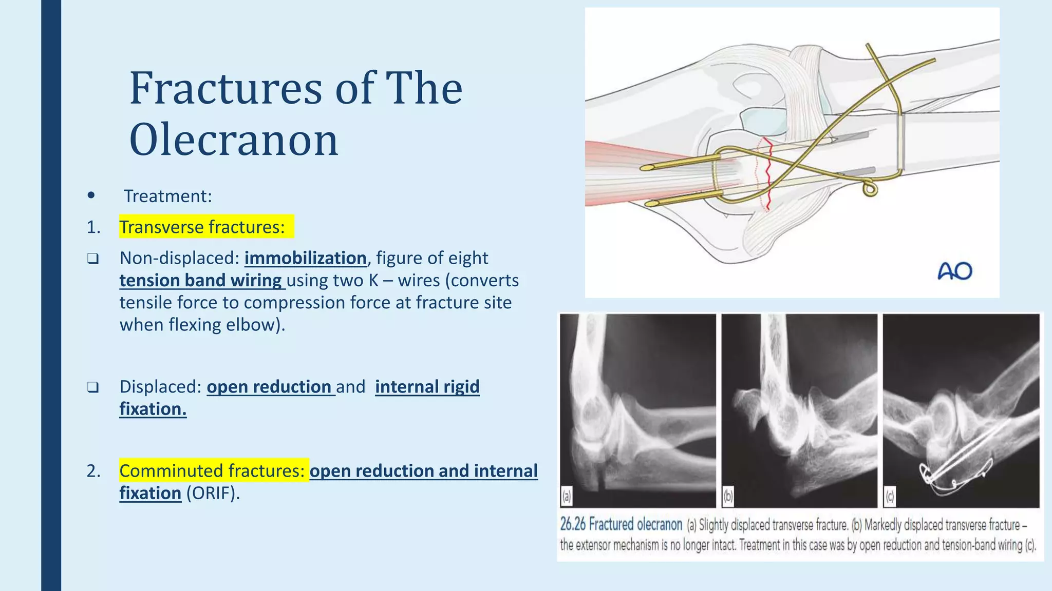 Upper limb fractures | PPTX