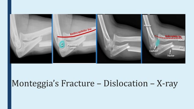 Upper limb fractures | PPTX | Death, Injury, or Military Conflict ...