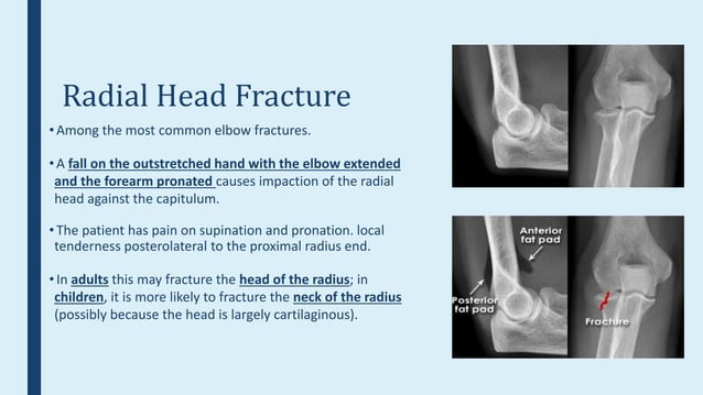 Upper limb fractures | PPTX | Death, Injury, or Military Conflict ...