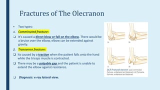 Upper limb fractures | PPTX