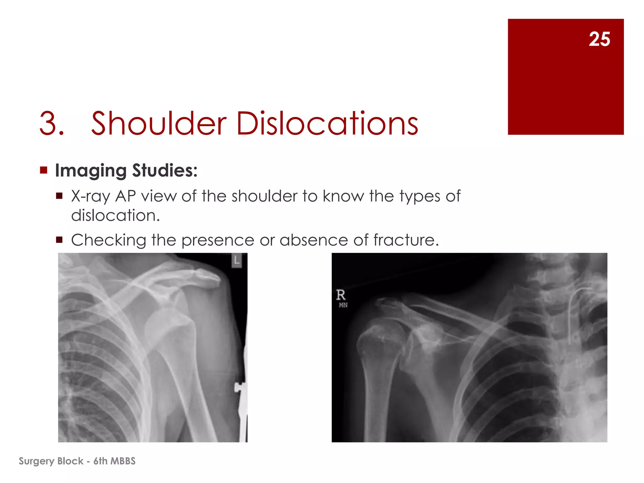 Fractures and Dislocations of Upper Limb | PPTX