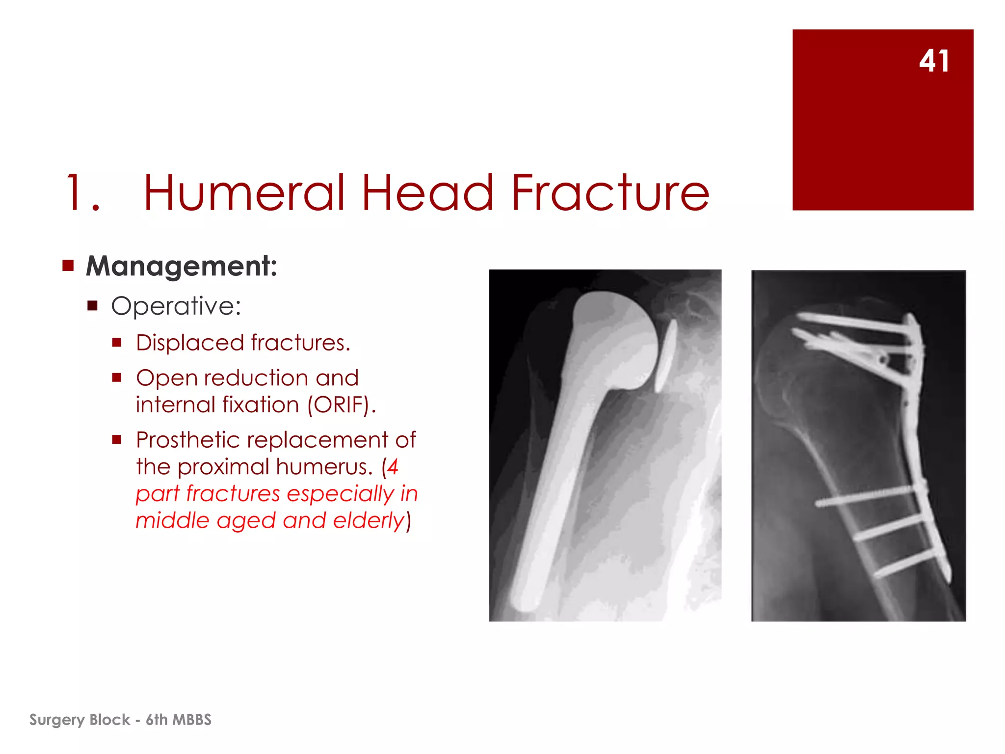 Fractures and Dislocations of Upper Limb | PPTX