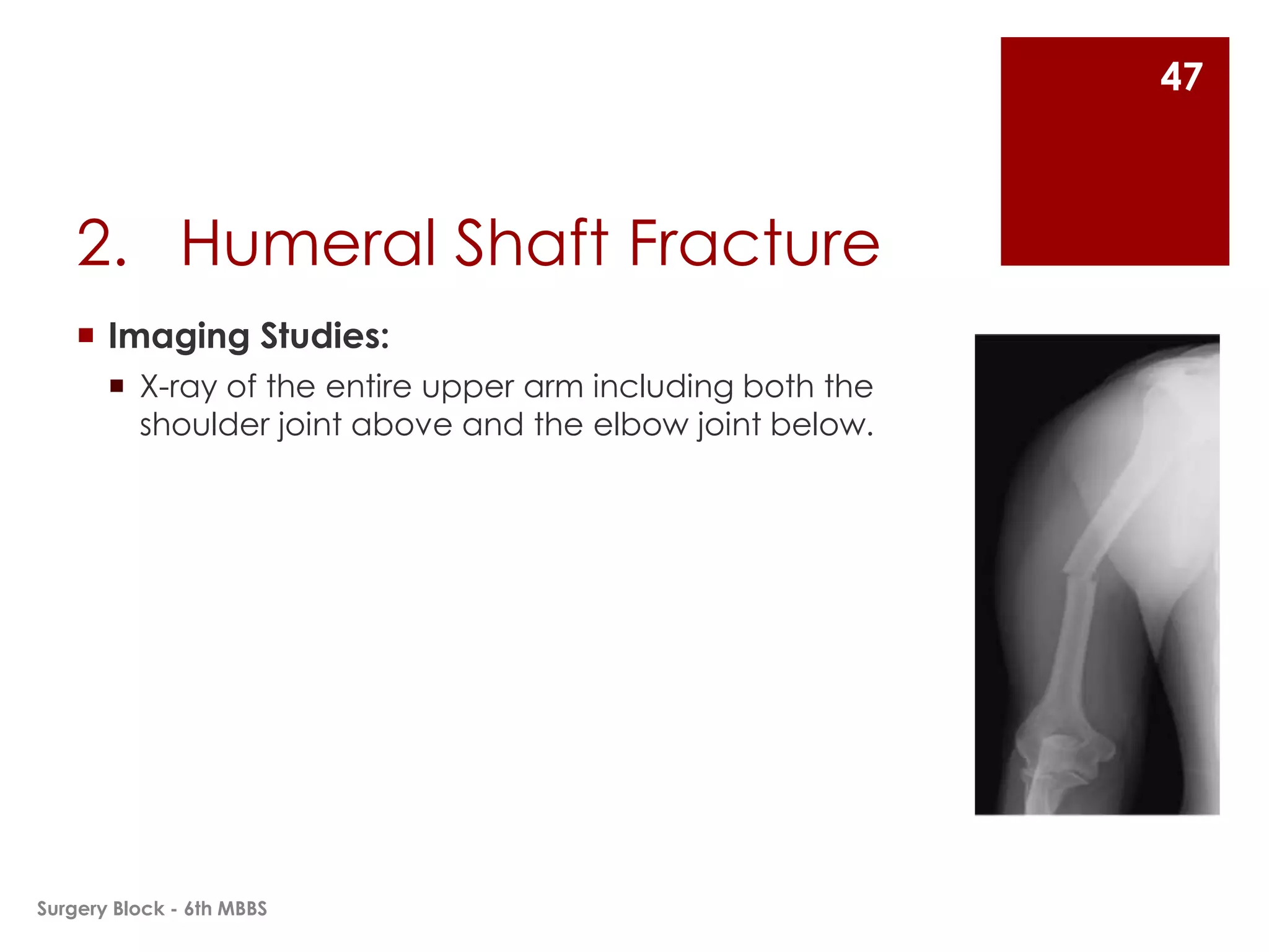 Fractures and Dislocations of Upper Limb | PPTX