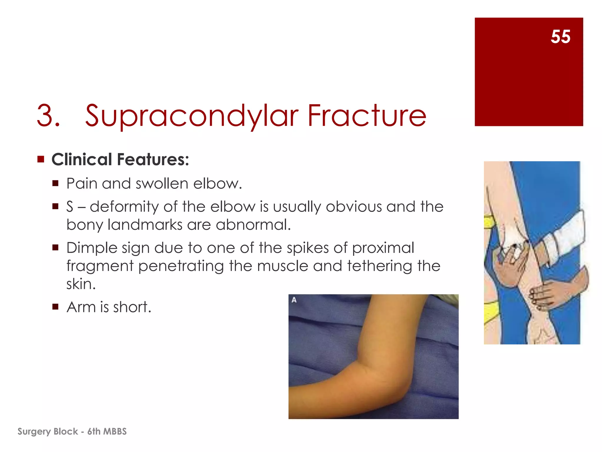 Fractures and Dislocations of Upper Limb | PPTX