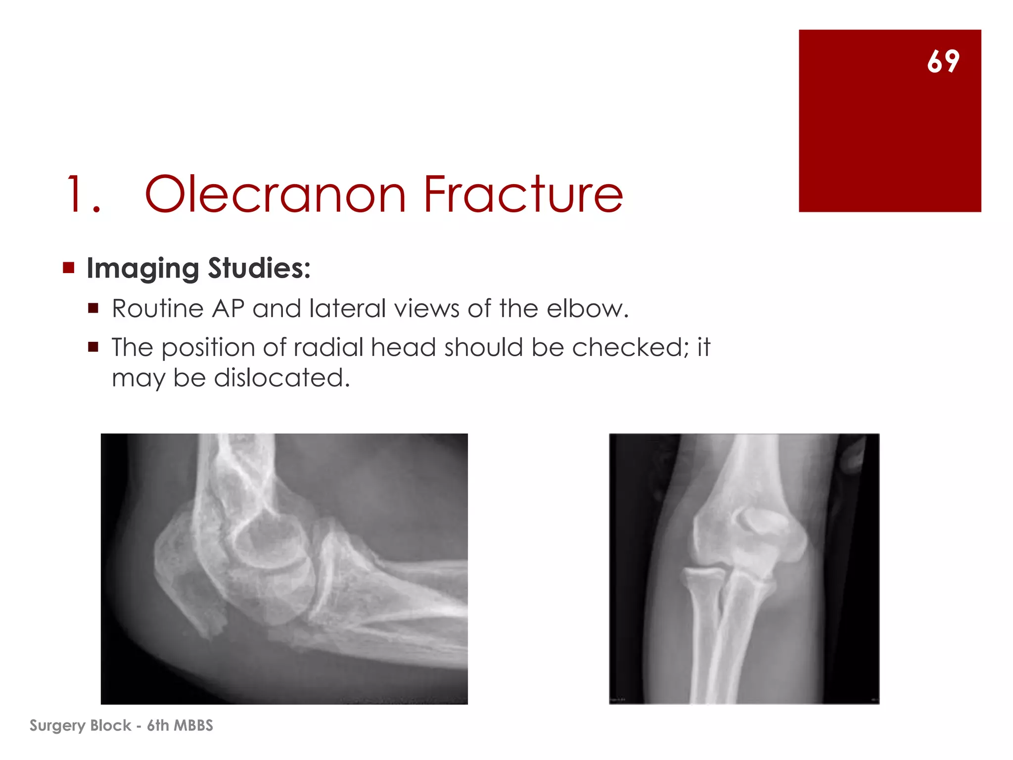 Fractures and Dislocations of Upper Limb | PPTX
