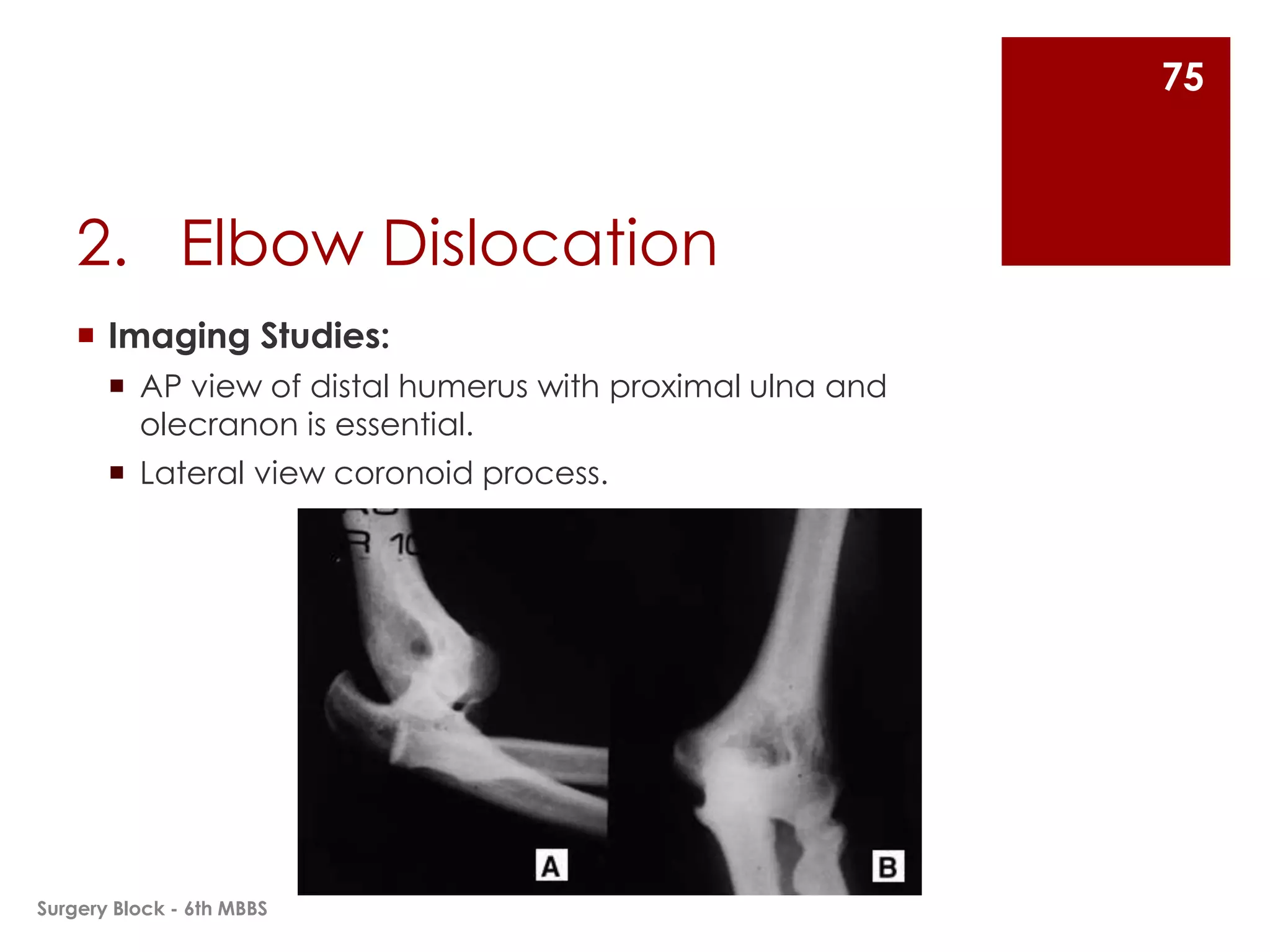 Fractures and Dislocations of Upper Limb | PPTX