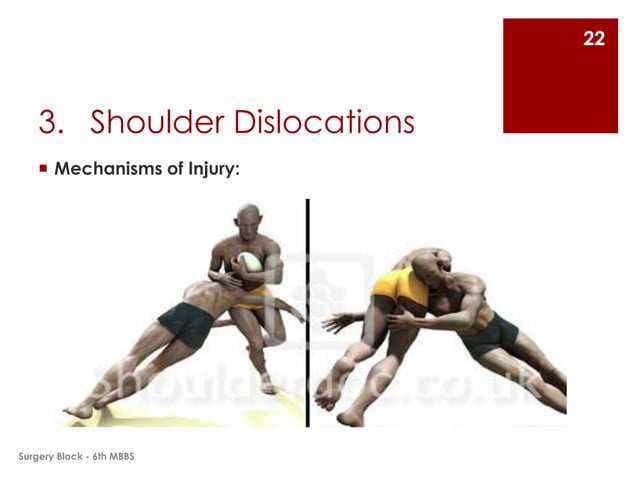 Fractures and Dislocations of Upper Limb | PPTX