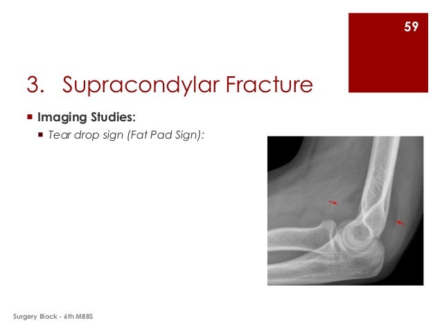 Fractures and Dislocations of Upper Limb