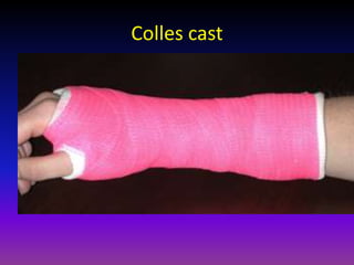 Upperlimb fractures bpt | PPTX