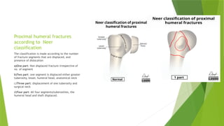 Upper limb fractures presentation and management | PPTX