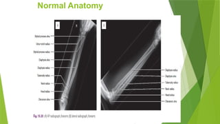 Upper limb fractures presentation and management | PPTX