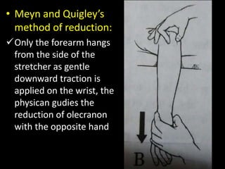 Upper limb fractures (part2) | PPTX