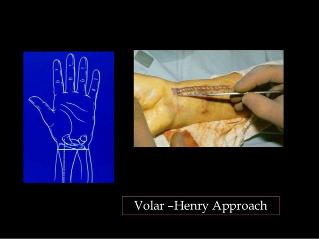 Upper limb fractures (part2)