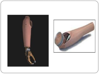 Upper limb functional prosthesis | PPTX
