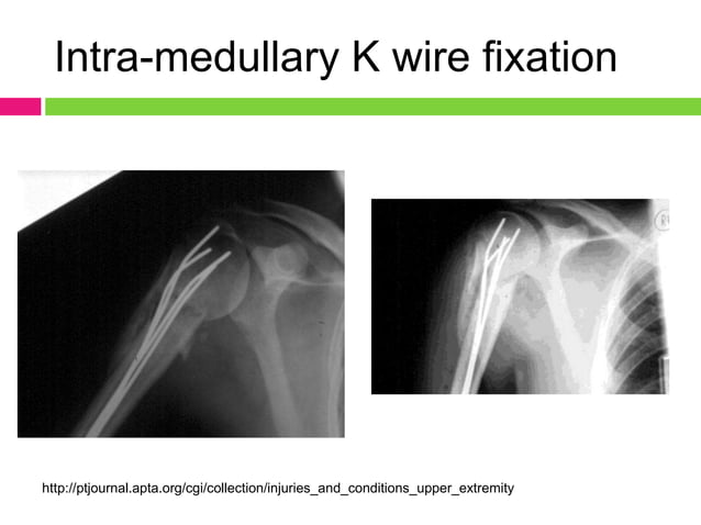 Upper_limb_injuries_x_raysjBqbbsbdhns.ppt