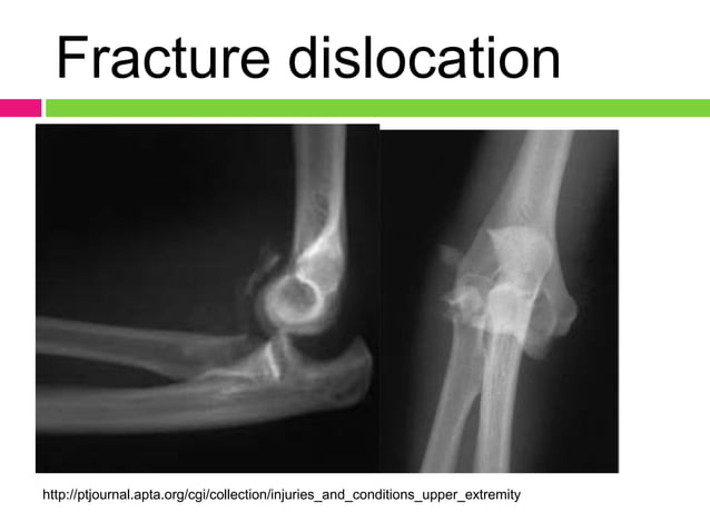 Upper_limb_injuries_x_raysjBqbbsbdhns.ppt