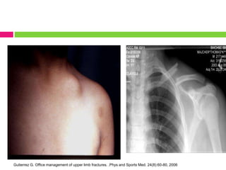 Upper_limb_injuries_x_raysjBqbbsbdhns.ppt