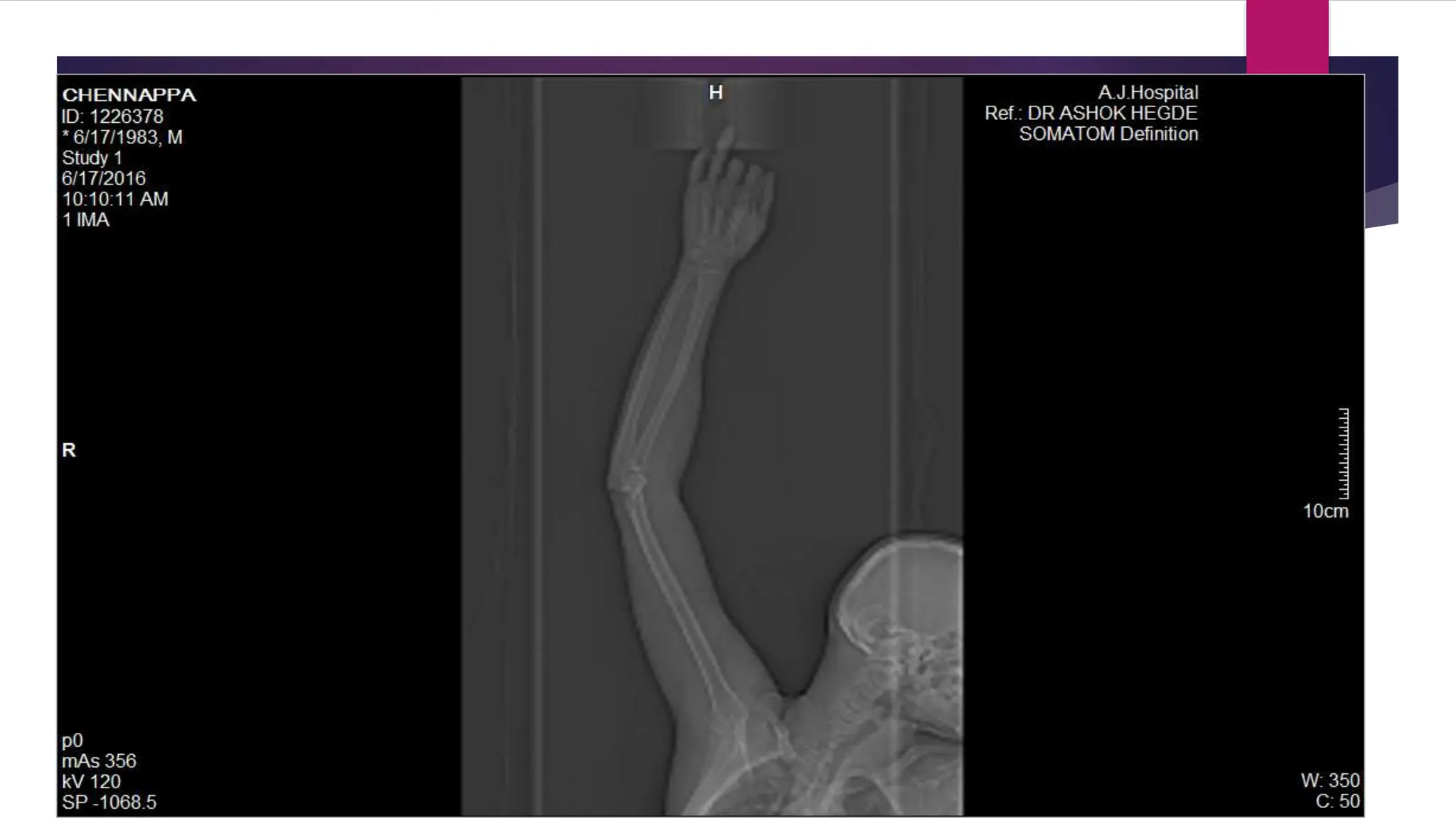 UPPER LIMB ISCHAEMIA.pptx