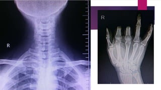 UPPER LIMB ISCHAEMIA.pptx