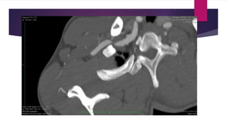 UPPER LIMB ISCHAEMIA.pptx