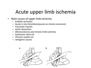 Upper limb ischemia | PPTX