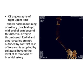Upper limb ischemia | PPTX