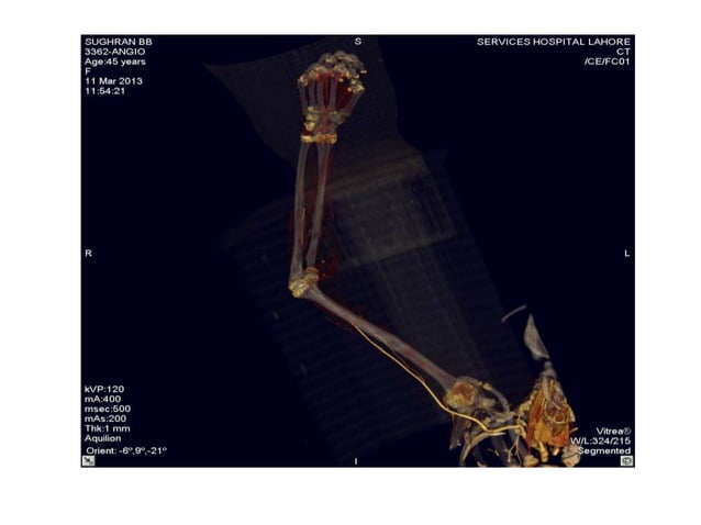 Upper limb ischemia | PPTX