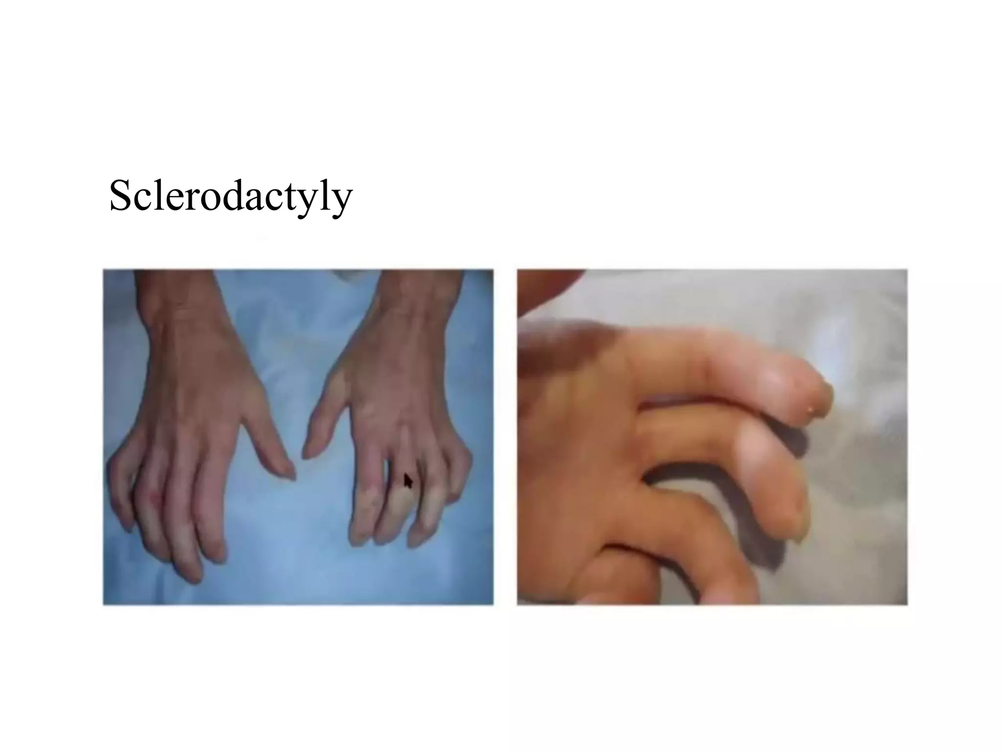 upper limb ischemia ppt.pptx