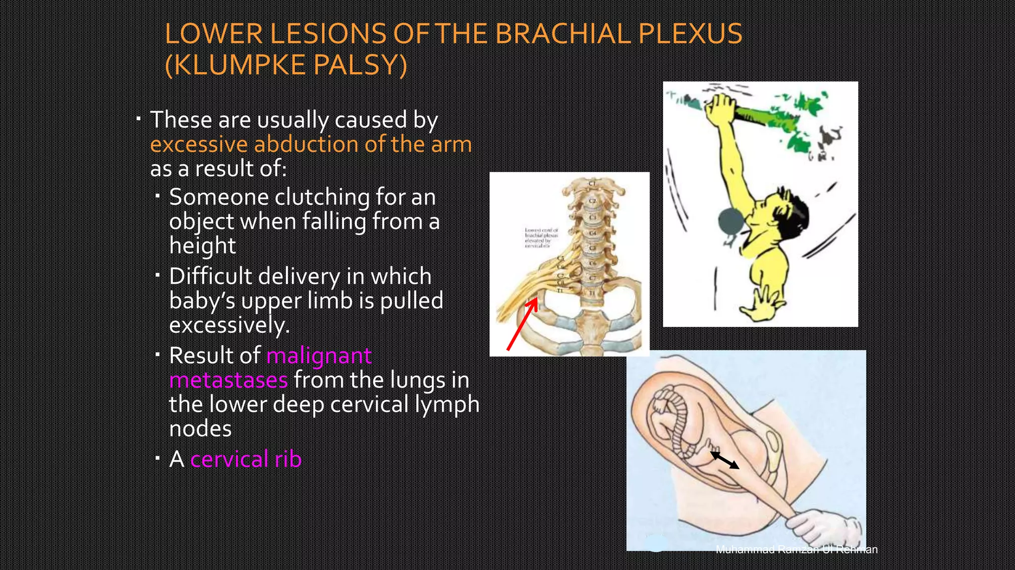 Upper limb nerve injuries | PPT