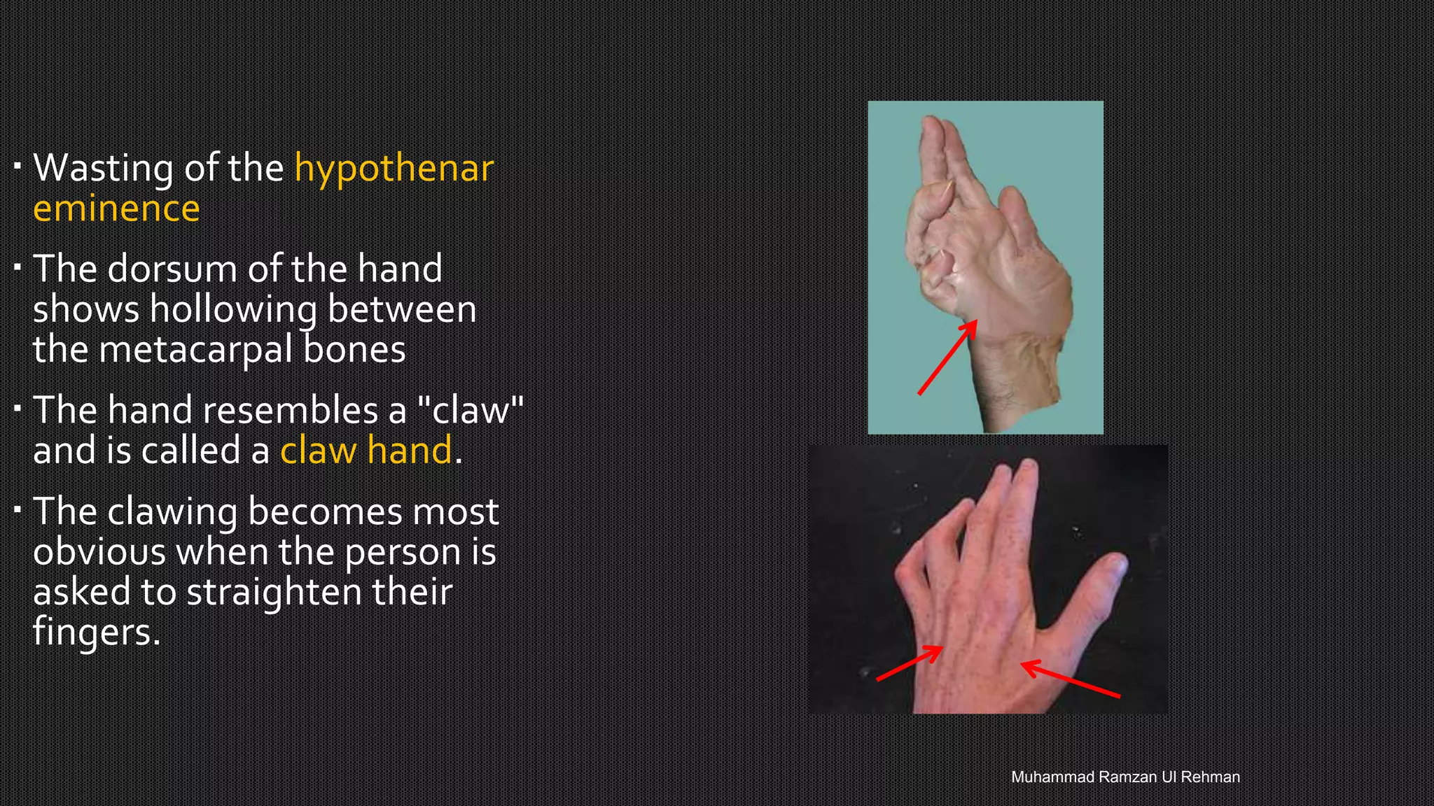 Upper limb nerve injuries | PPT