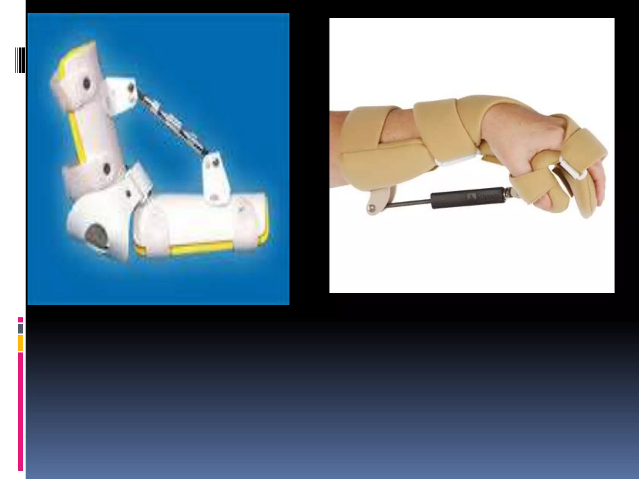 Upper limb orthosis | PPTX