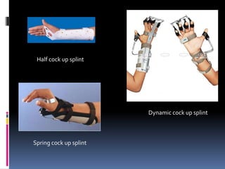 Upper limb orthosis | PPTX